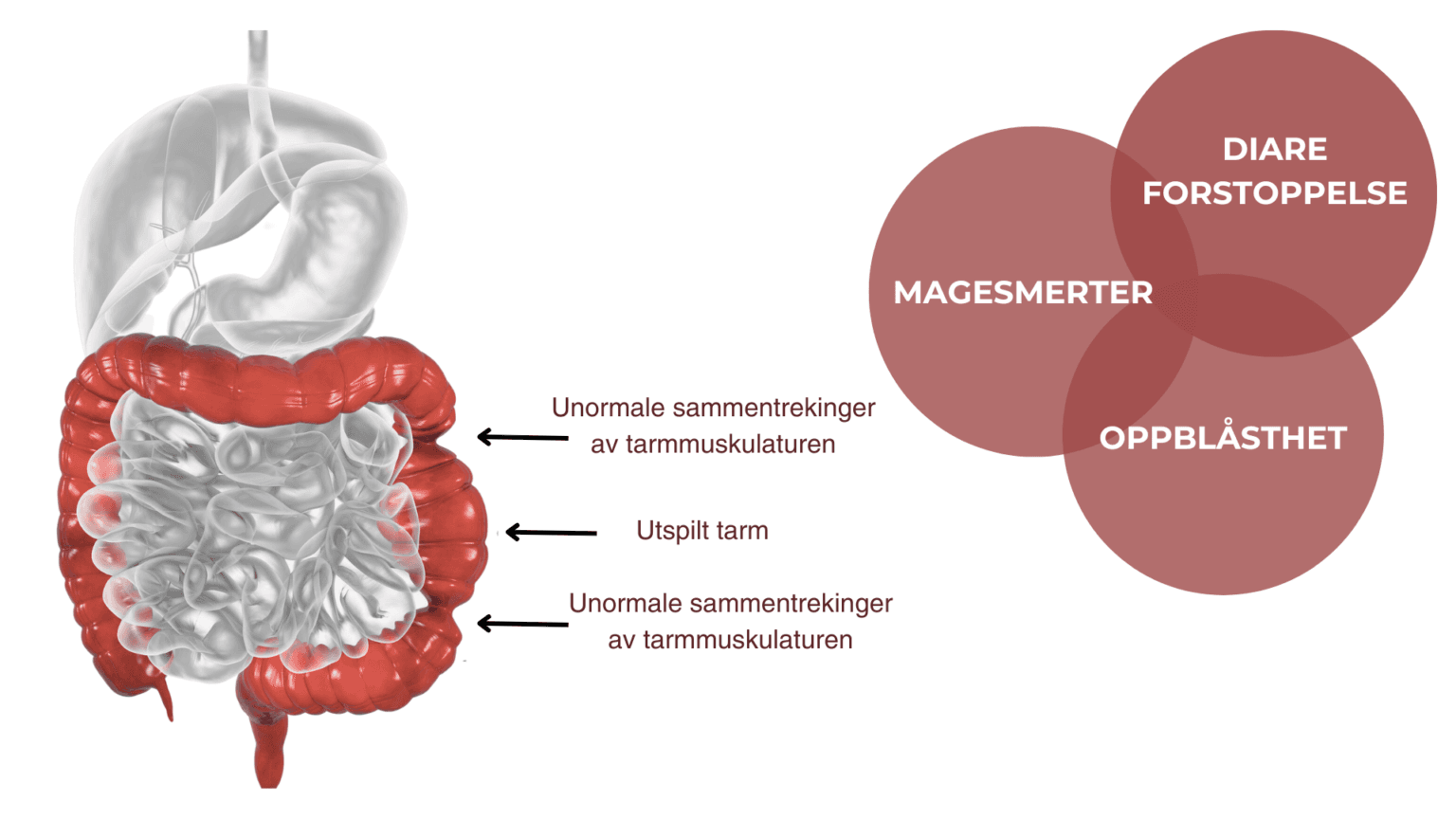 Irritabel tarmsyndrom (IBS) - symptomer, årsak og behandling - Blodsjekk